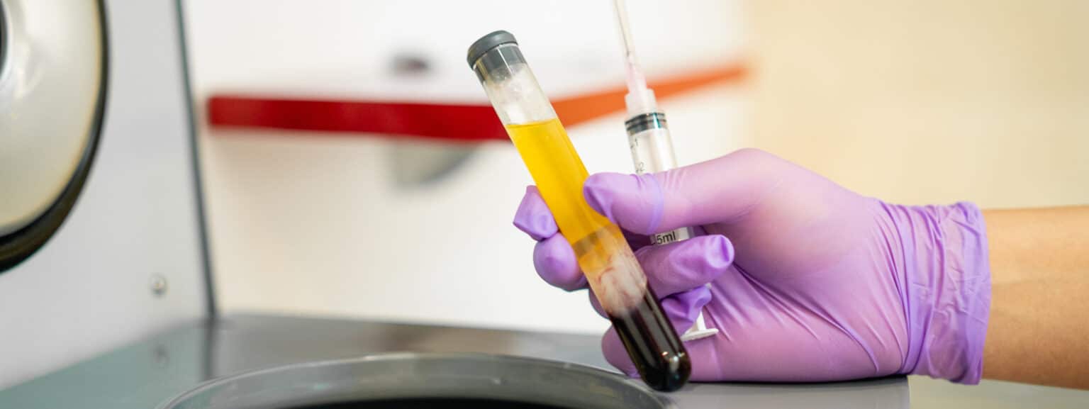 PRFM for Skin Rejuvenation Charleston & Mount Pleasant SC