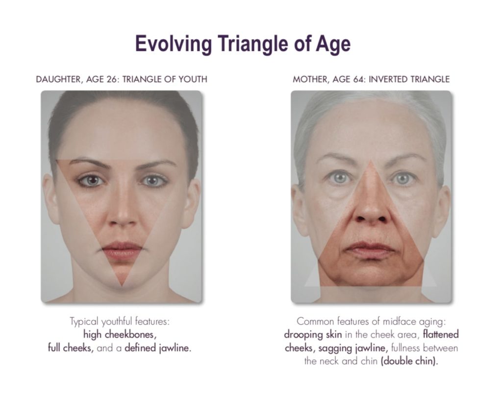 JUVÉDERM Charleston - Juvederm injectable Gel Mount Pleasant